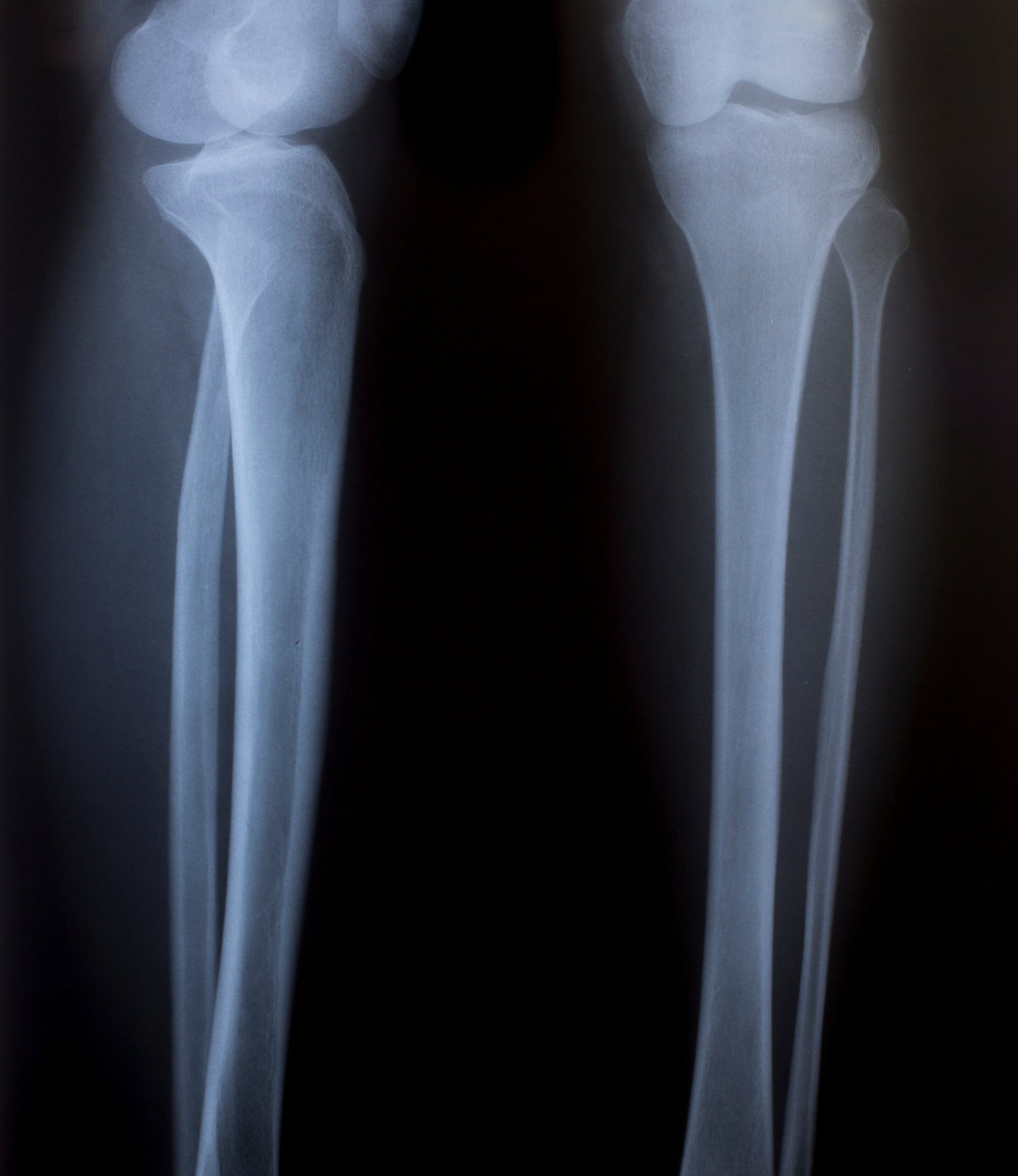 The Largest Human Bone: Fascinating Facts – Animus Medicus US